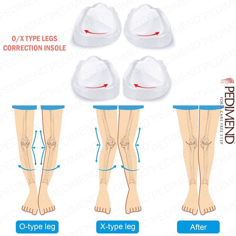 PEDIMEND™ Supination and Pronation Corrective Heel Insoles - O/X Type ...
