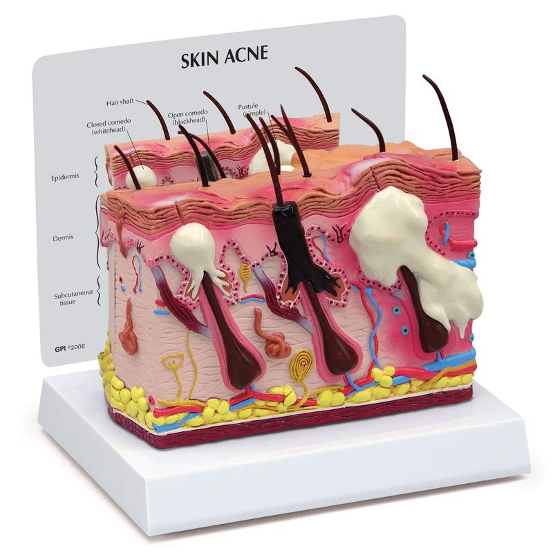 GPI Anatomicals - Skin Acne Model, Cross-Section Model Showing Normal ...