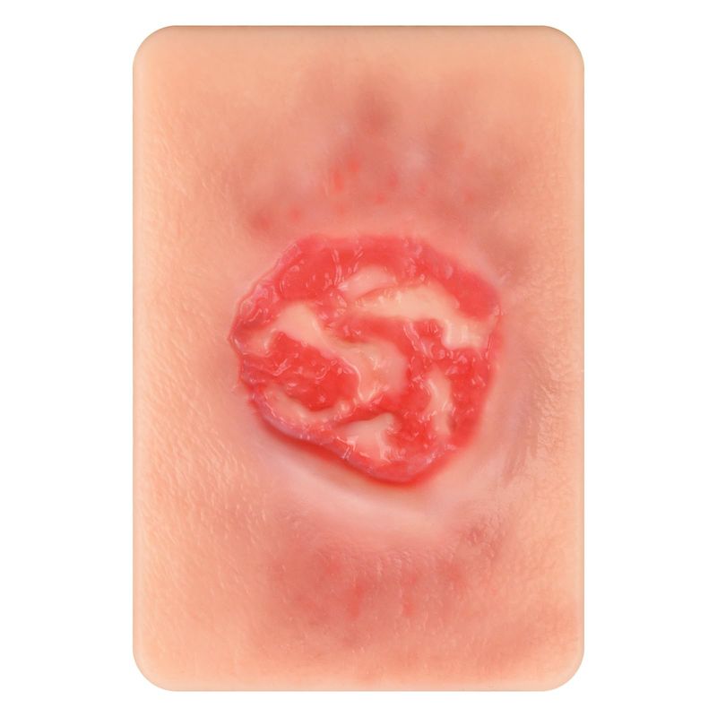 MedEduQuest Pressure Ulcer Wound Model Stage 3 Pocket Size, Wound ...