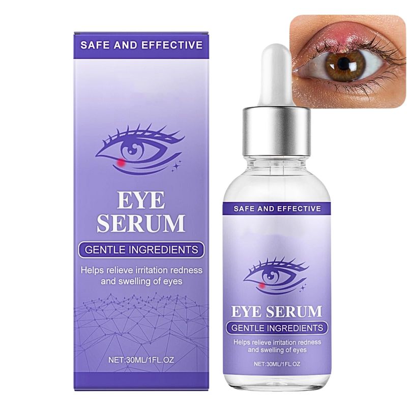 Stye Eye Treatment, Under Eye Serum for Styes Chalazion Blepharitis ...
