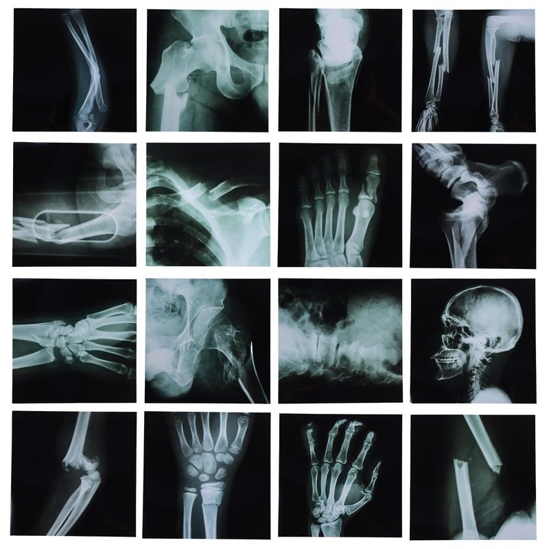 16 Pcs Broken Bones X-Ray Set, Black and White Skeleton Pretend X-Rays ...