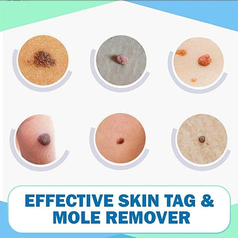 Tags & Moles Remover Device – Natural & Effective Skin Tag Remover Pen ...