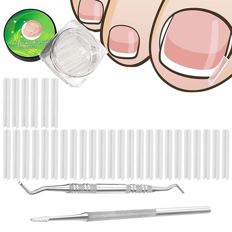 (30+2) Pack Ingrown Toenail Correction Treatment Kit, 30PCS Ingrown ...
