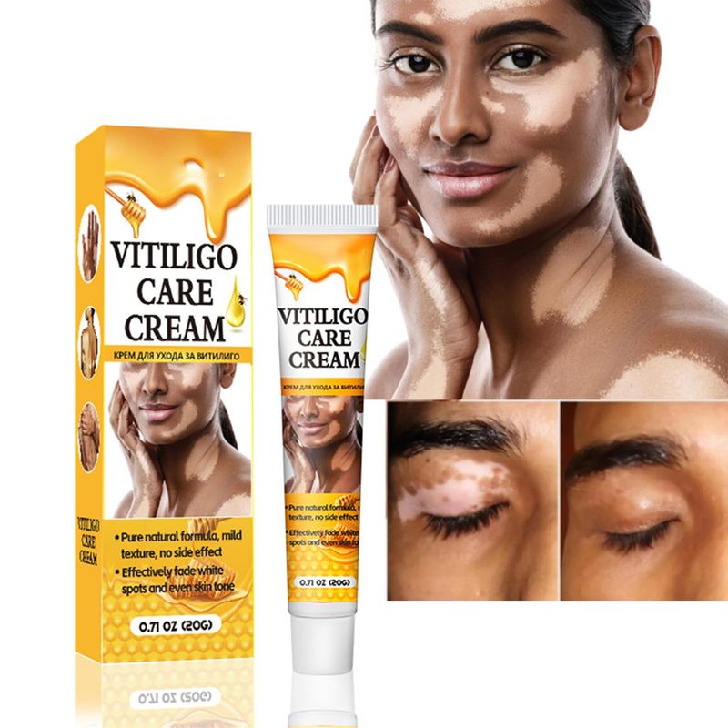 Grgowe Vitiligo Creme,Weißer Fleck Creme,Vitiligo-Creme Für Weiße ...