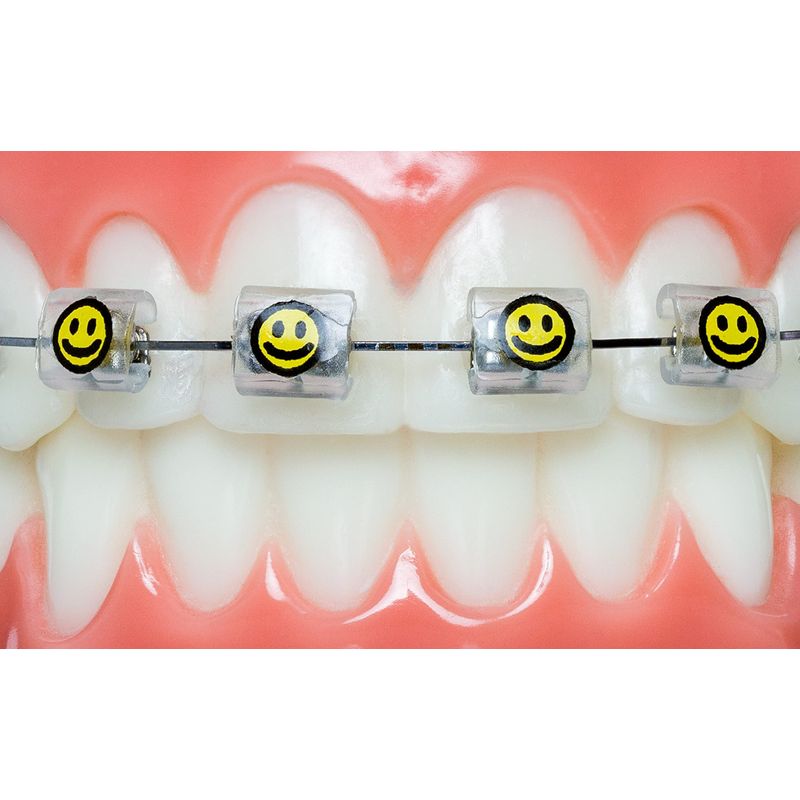 Braces Wax Alternative Bracket Cover Bumper Orthodontic Braces ...