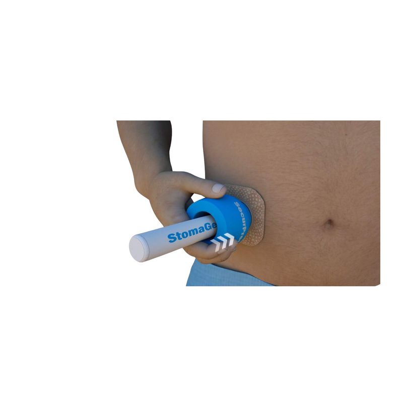 SECURPRESS Stoma Secure Device - 1-Pack - (1 3/8"), for Any Type of ...