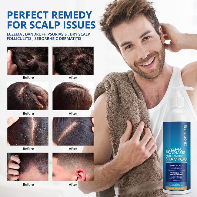 Seborrheic Dermatitis Scalp Shampoo